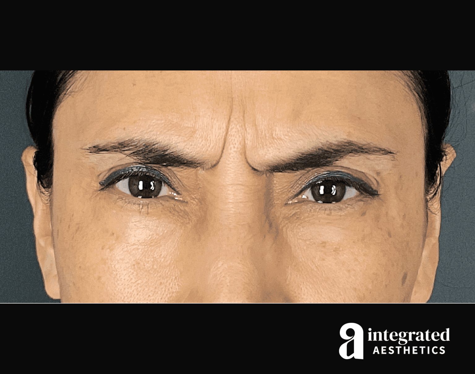 BOTOX in The Woodlands and Spring, TX | Integrated Aesthetics