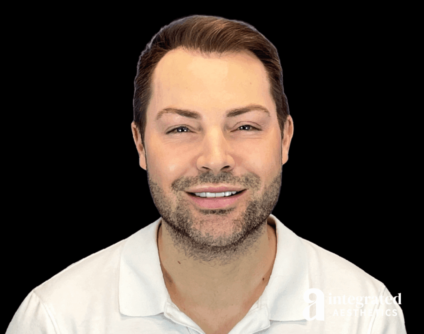 Dermal Filler Revision Case Study The Woodlands | Dr. Chiang